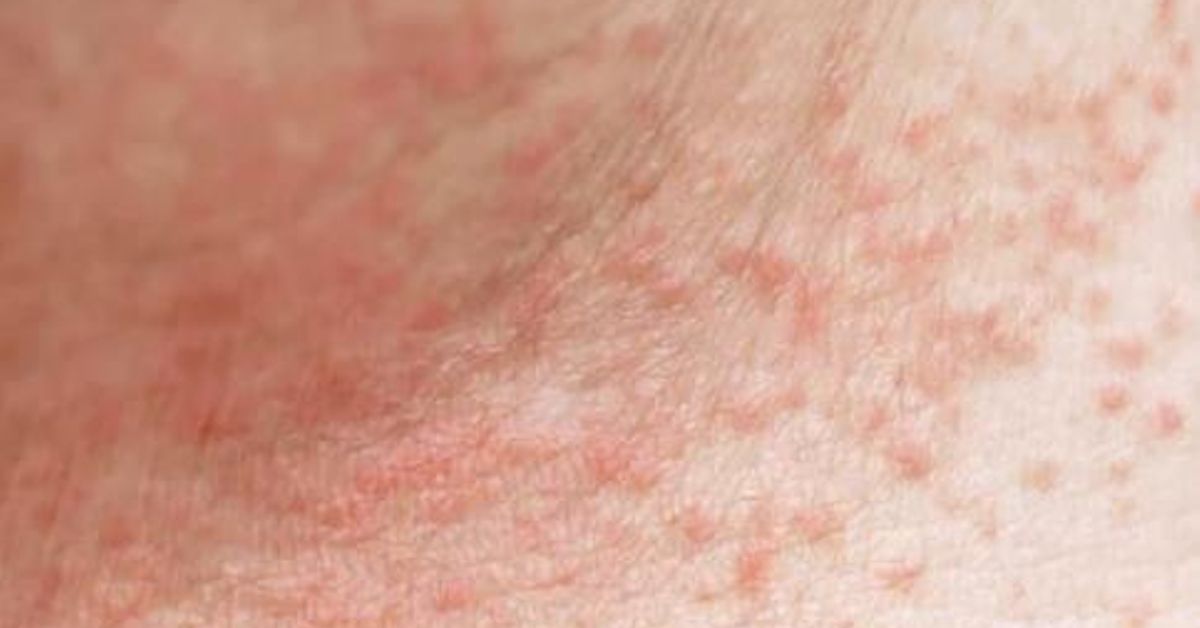 Sudamina y calor en verano: cómo reconocer y tratar urticaria térmica ...