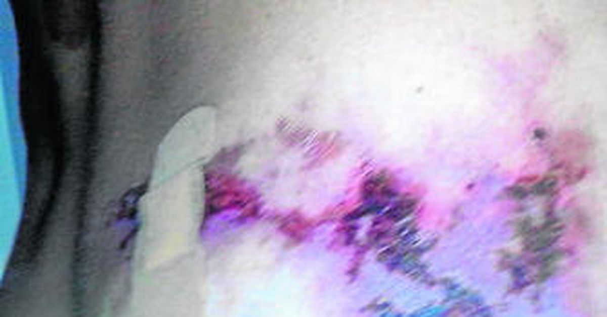 Diez meses con necrosis cutánea tras una inyección en el Clínico