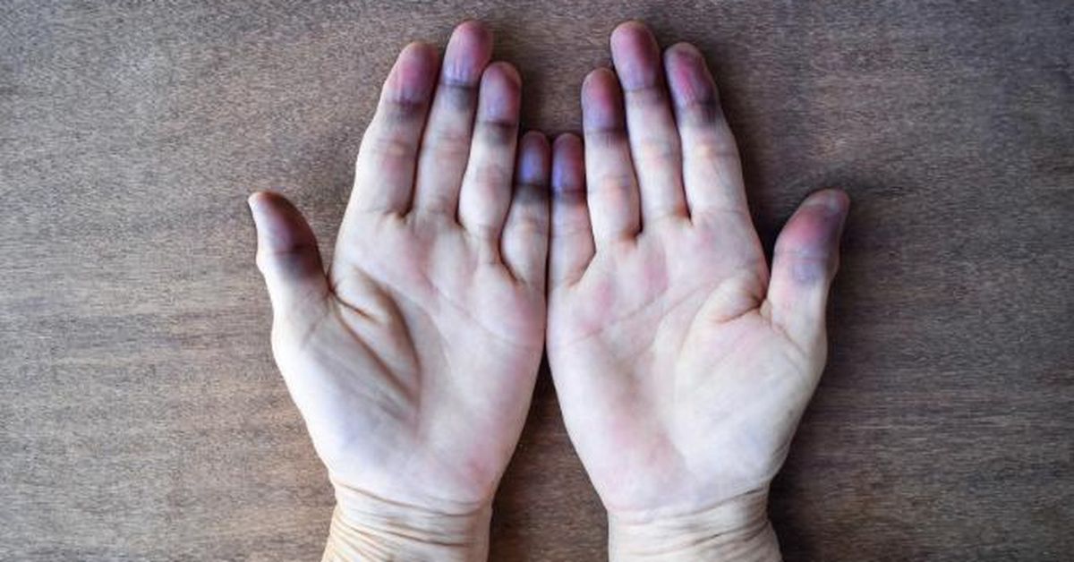 En qué consiste la cianosis, el síntoma de una enfermedad que está ...