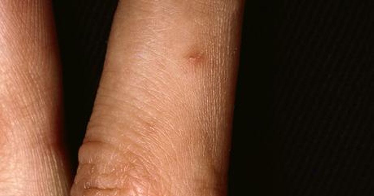 La sarna: consejos para prevenir y tratar esta enfermedad