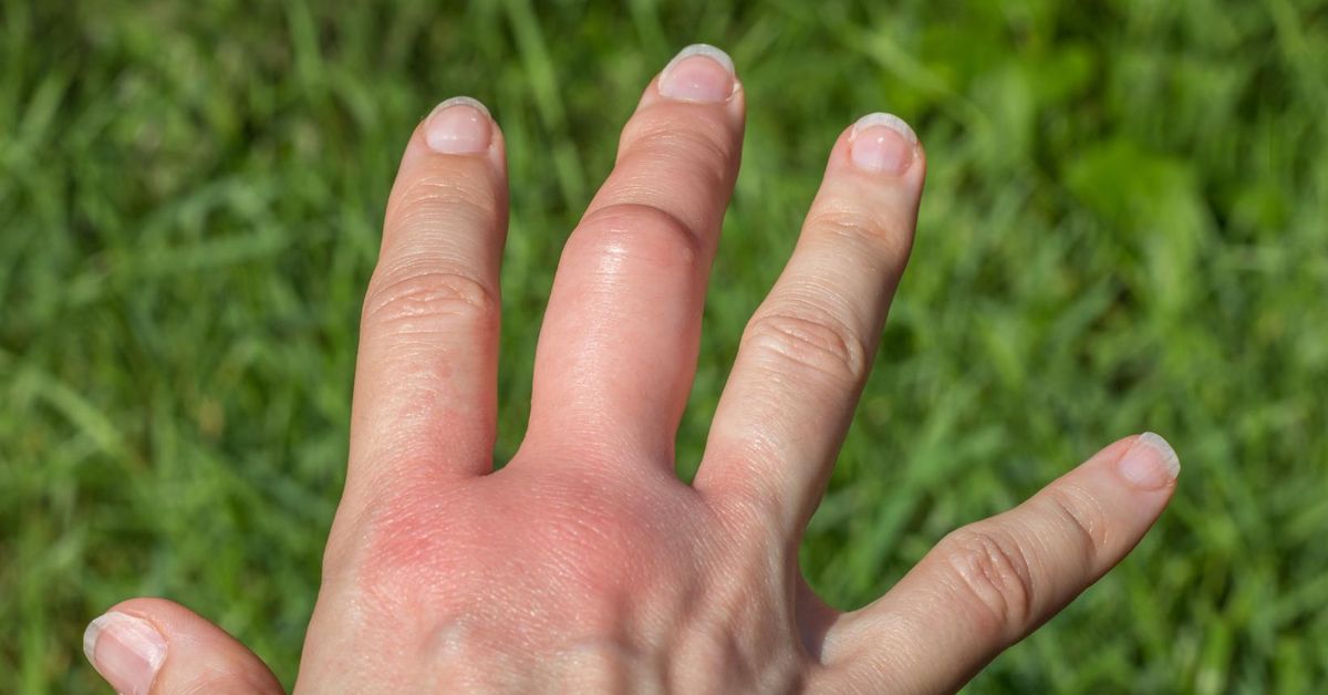 Síndrome de Skeeter: la severa reacción a las picaduras de mosquito que ...